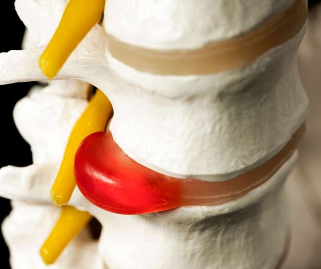 Spinal Stenosis Archives - Family Spine and Pain Care Institute